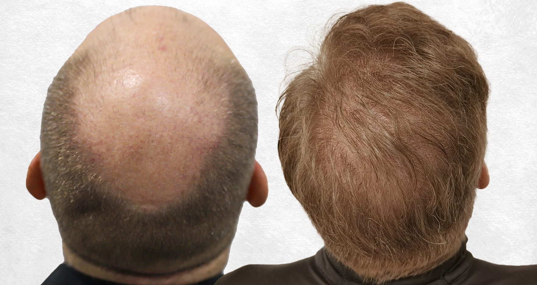 Crown Hair Transplant in Hyderabad - Before and After Results