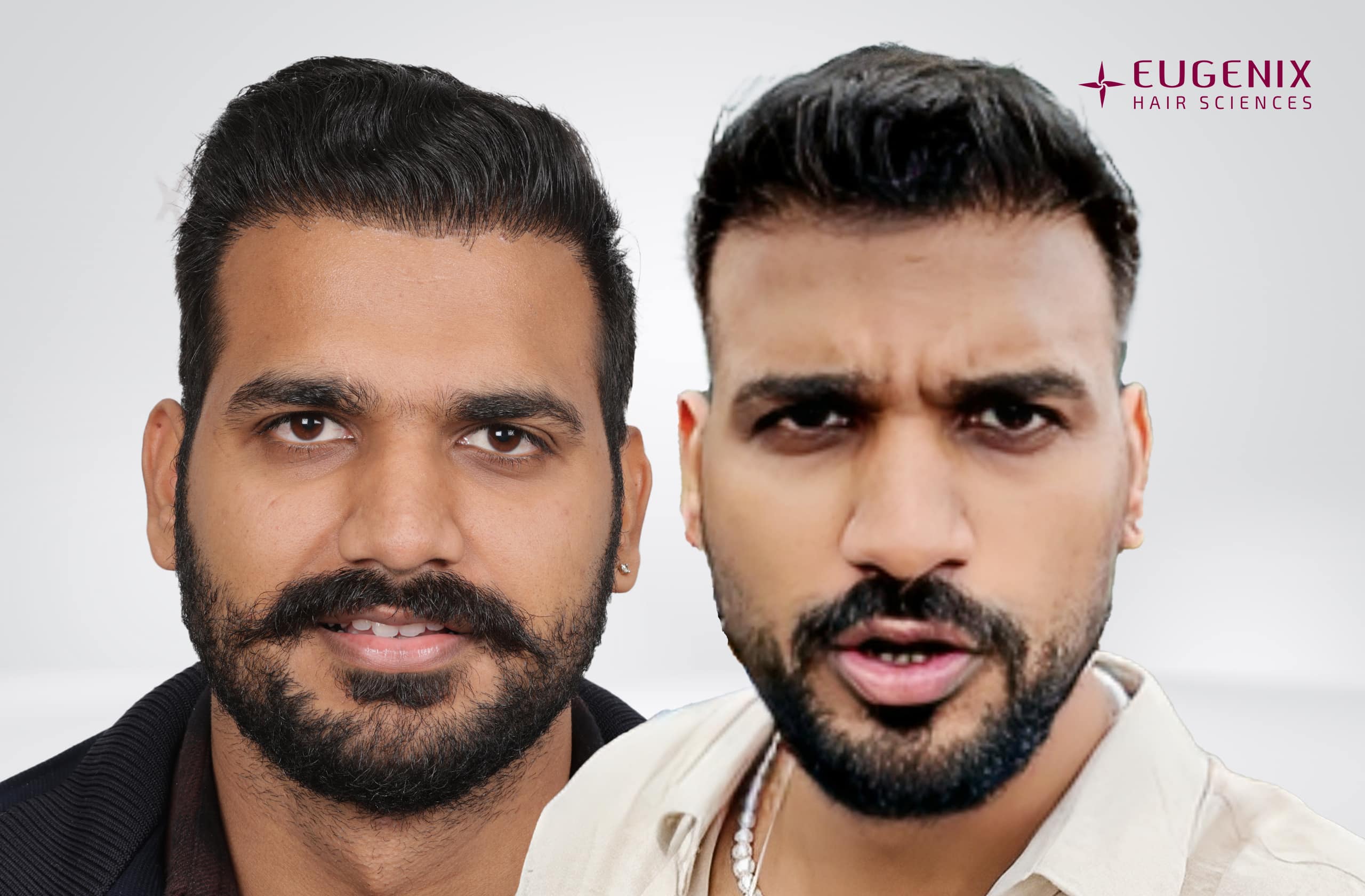 YouTuber Paramvir Singh Beniwal - Corrective Hair Transplant Before and ...