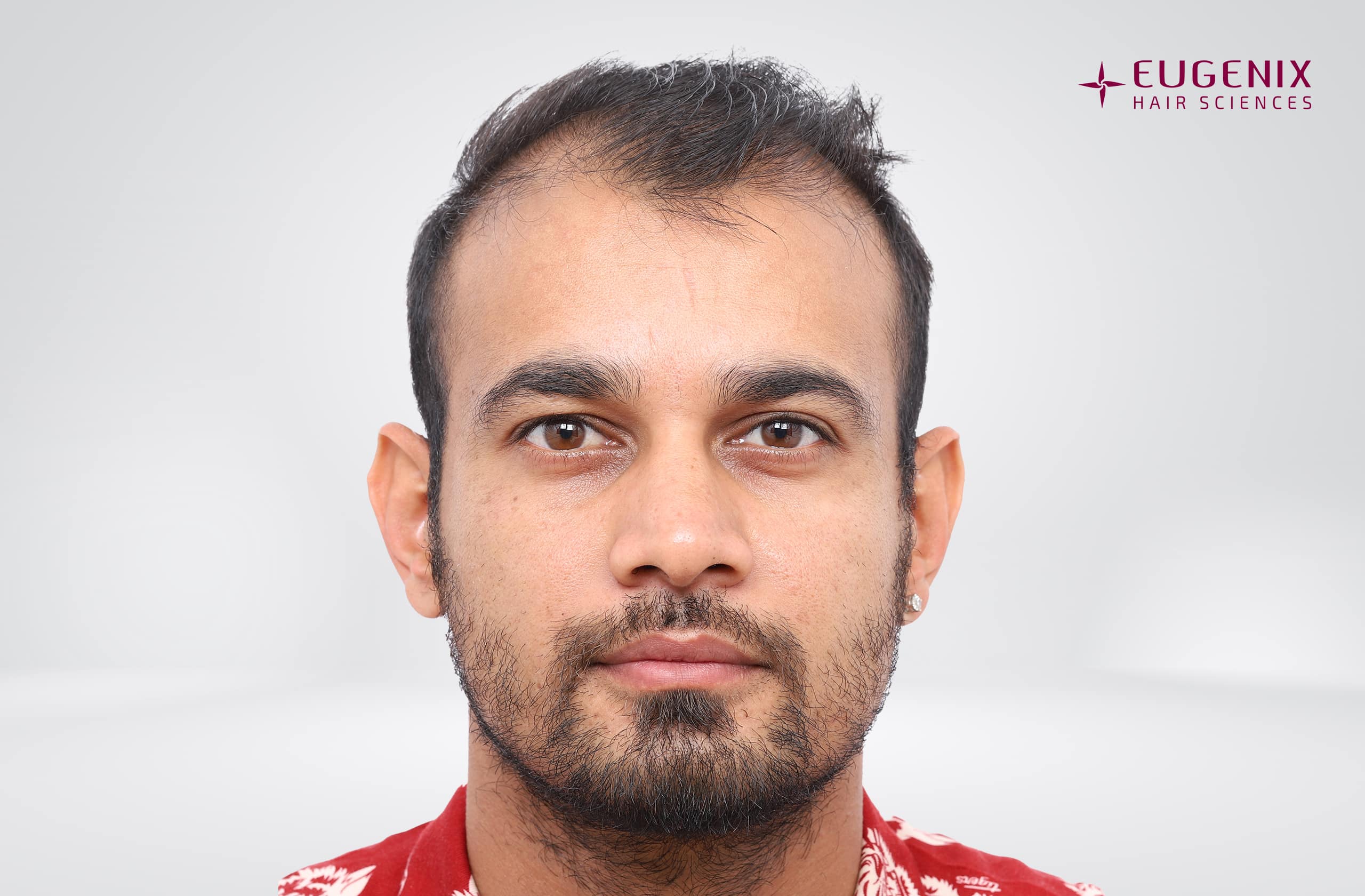 Siddharth Kaul - Norwood Class 3 Hair Transplant Results and Hair ...
