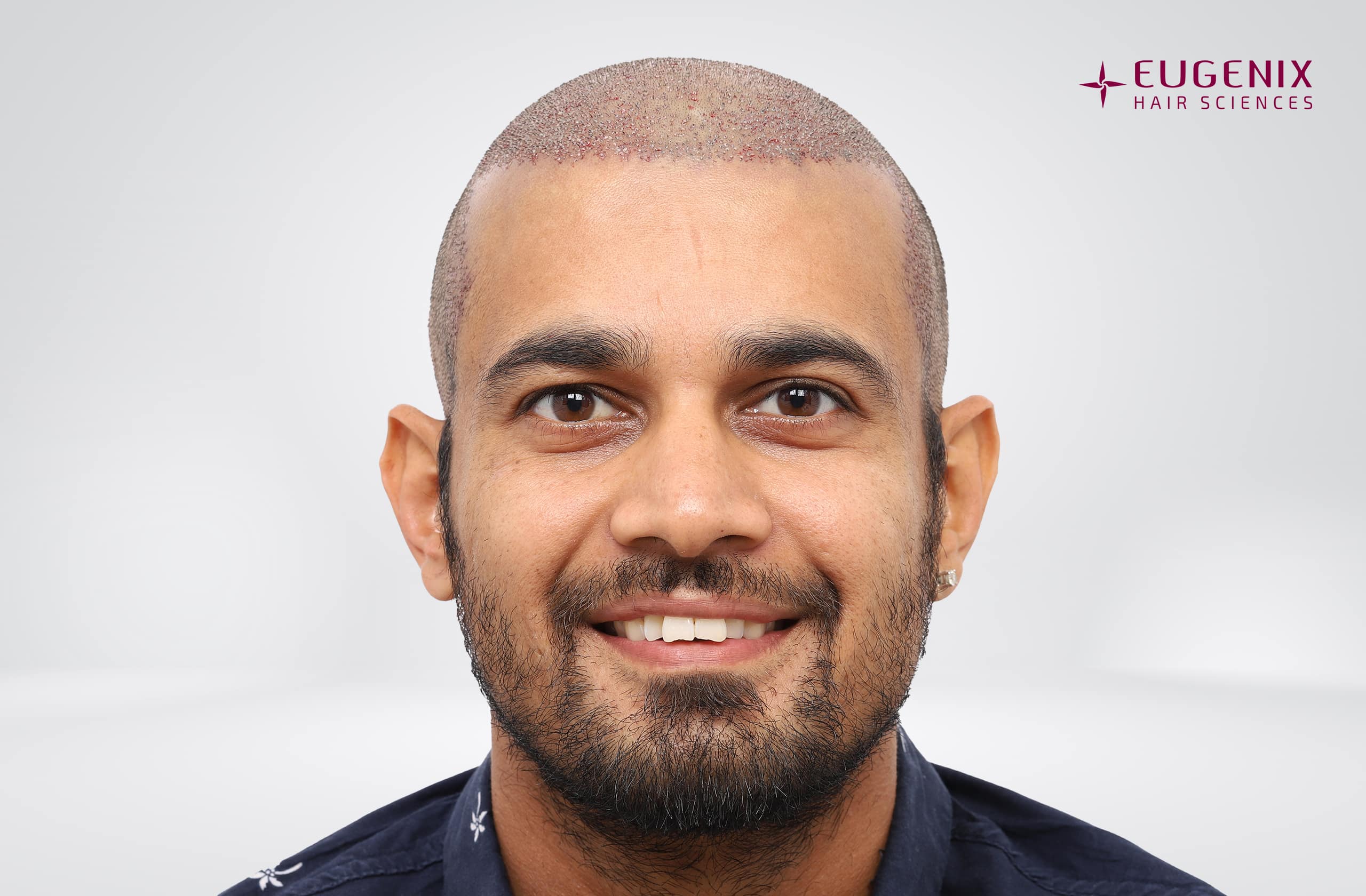 Siddharth Kaul - Norwood Class 3 Hair Transplant Results and Hair ...