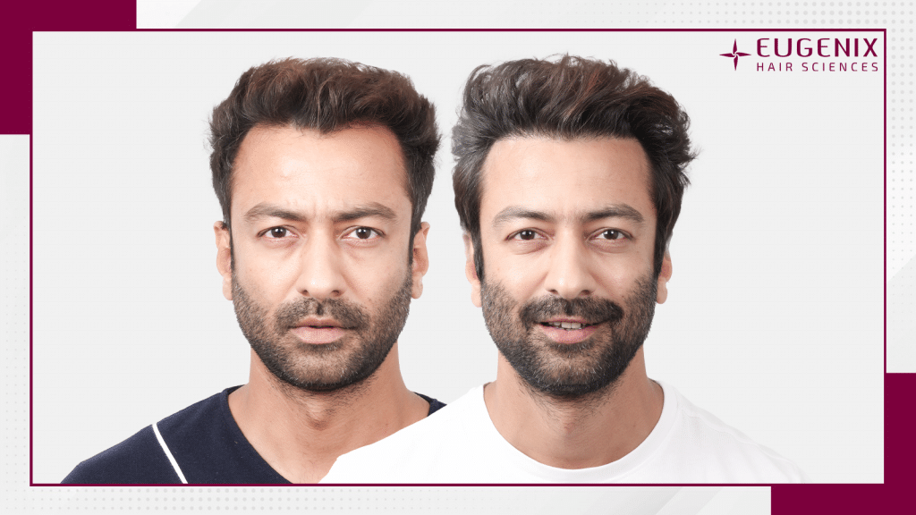 From Screen to Confidence: Indian Actor Jatin Shah’s Hair Transplant ...
